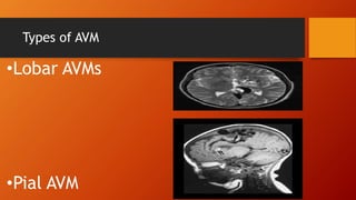 Stereotactic radiosurgery in arterio venous malformations | PPTX