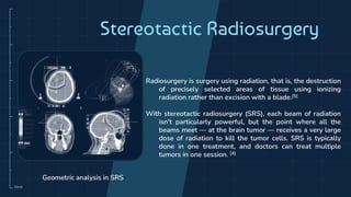 Stereotactic Radiosurgery in Brain Metastases.pdf
