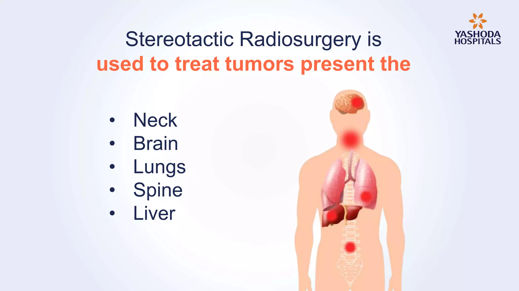 What Is Stereotactic Radiosurgery(SRS) | What Conditions Does It Treat ...