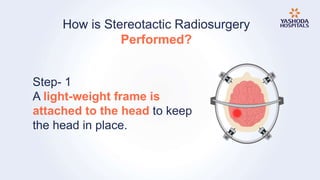 What Is Stereotactic Radiosurgery(SRS) | What Conditions Does It Treat? | PPTX | Surgery ...
