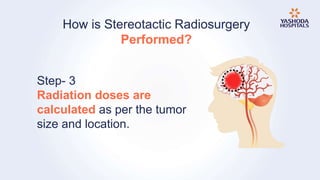 What Is Stereotactic Radiosurgery(SRS) | What Conditions Does It Treat ...