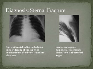 Sternal fracture | PPTX