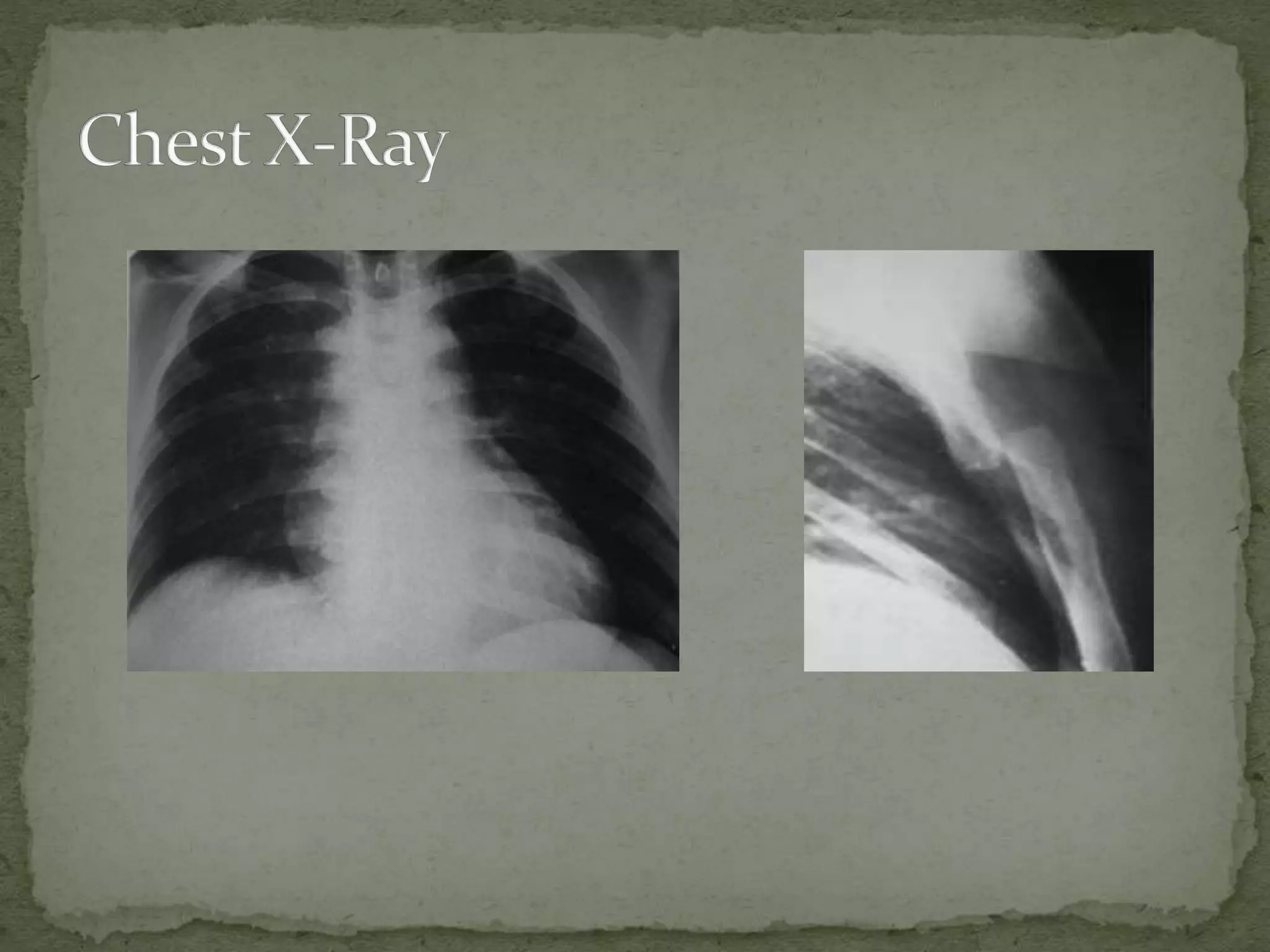 Sternal fracture | PPTX