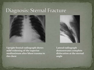 Sternal fracture | PPT