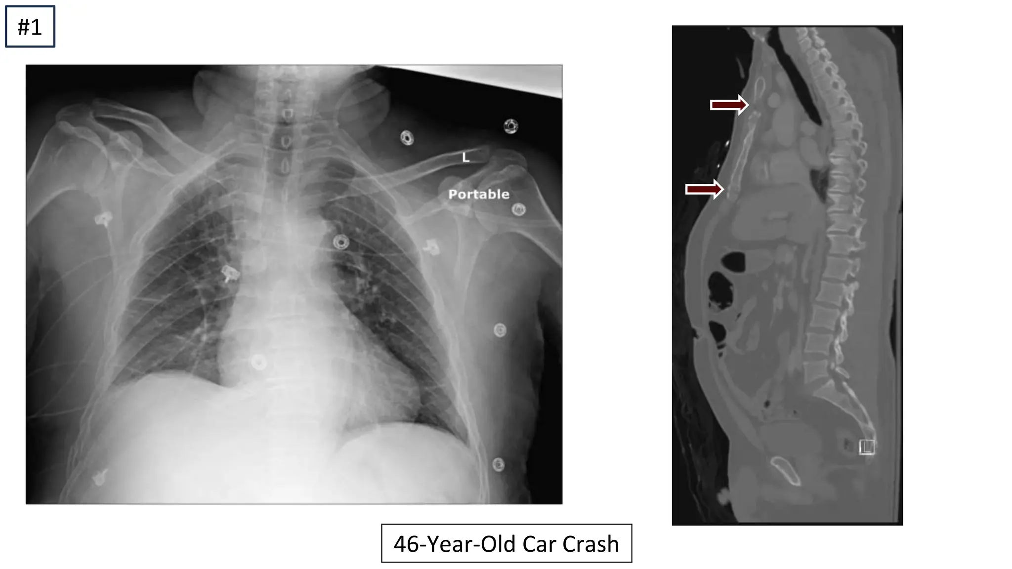 Sternal Fractures & Dislocations - EMGuidewire Radiology Reading Room ...