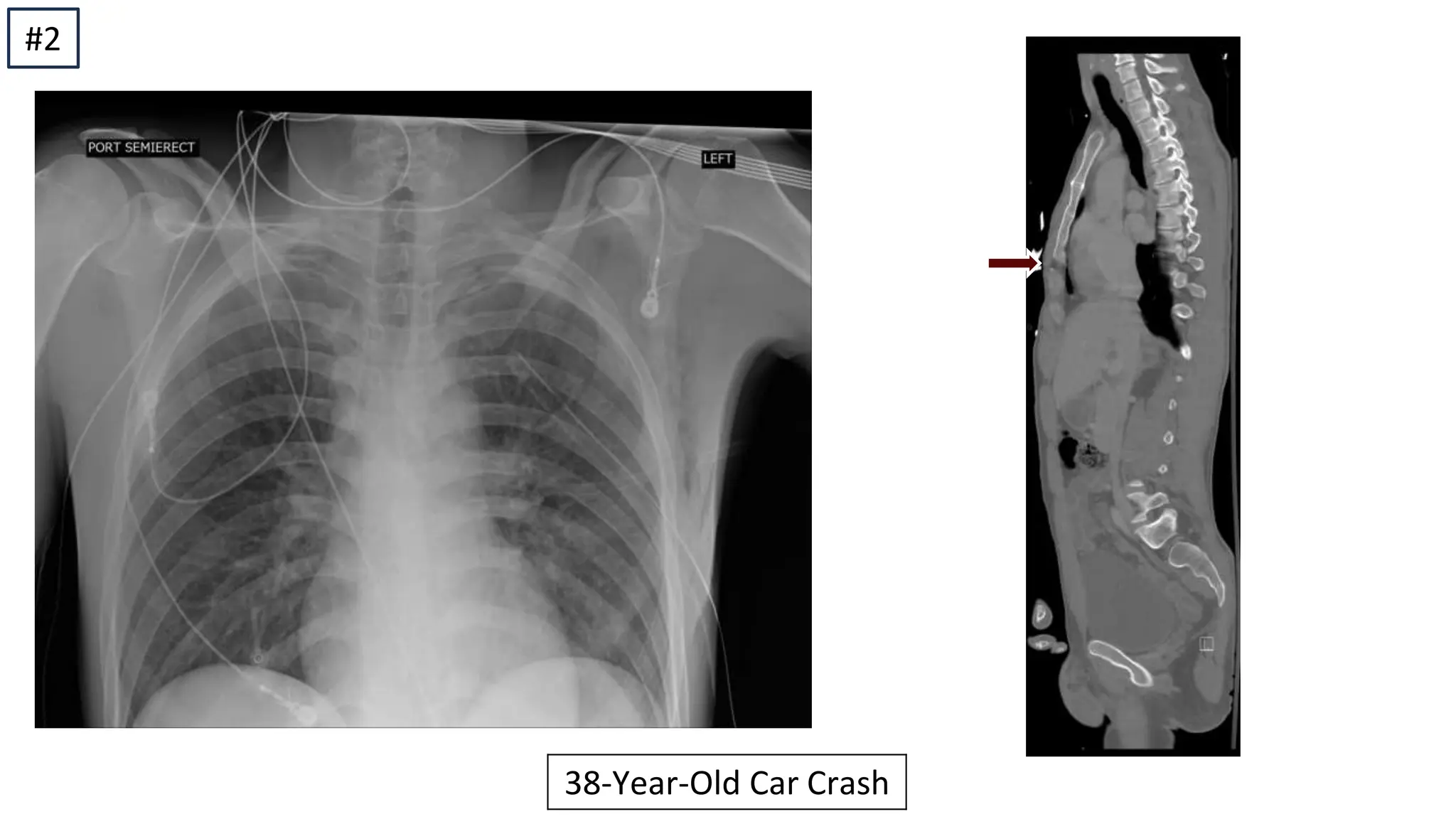 Sternal Fractures & Dislocations - EMGuidewire Radiology Reading Room ...