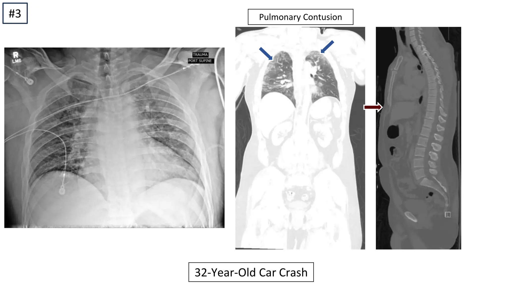 Sternal Fractures & Dislocations - EMGuidewire Radiology Reading Room ...