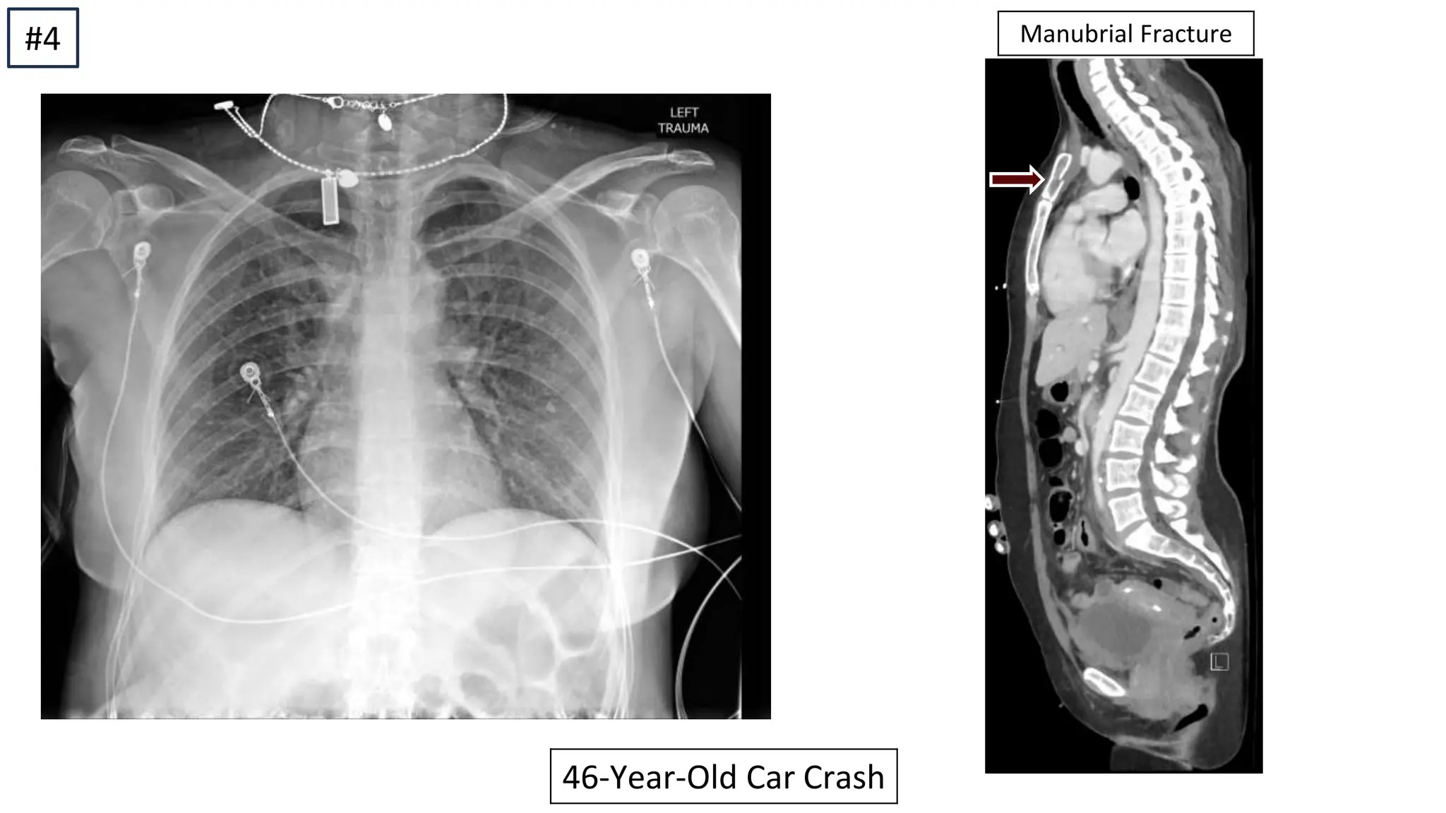 Sternal Fractures & Dislocations - EMGuidewire Radiology Reading Room ...