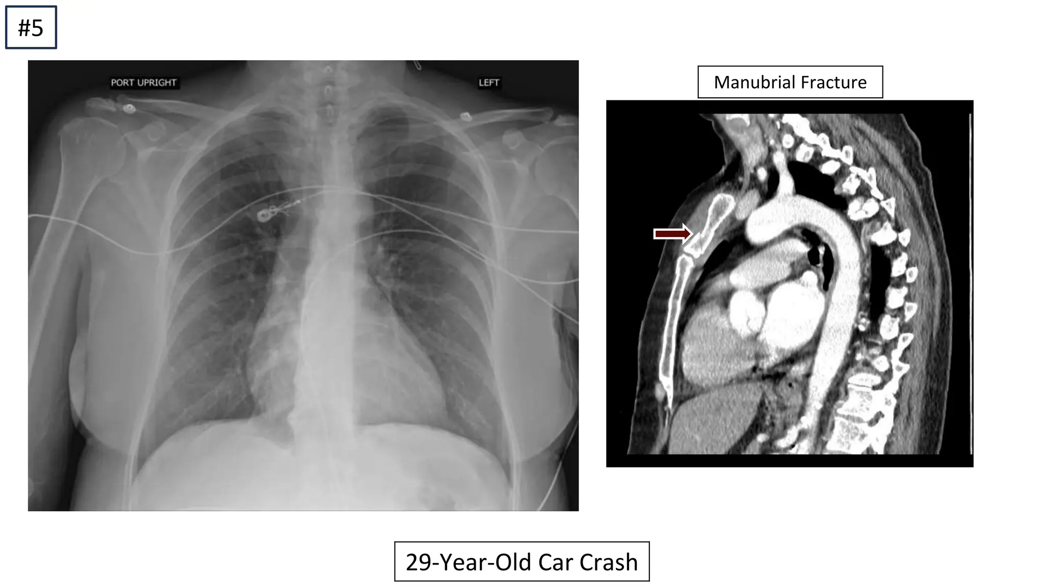 Sternal Fractures & Dislocations - EMGuidewire Radiology Reading Room ...