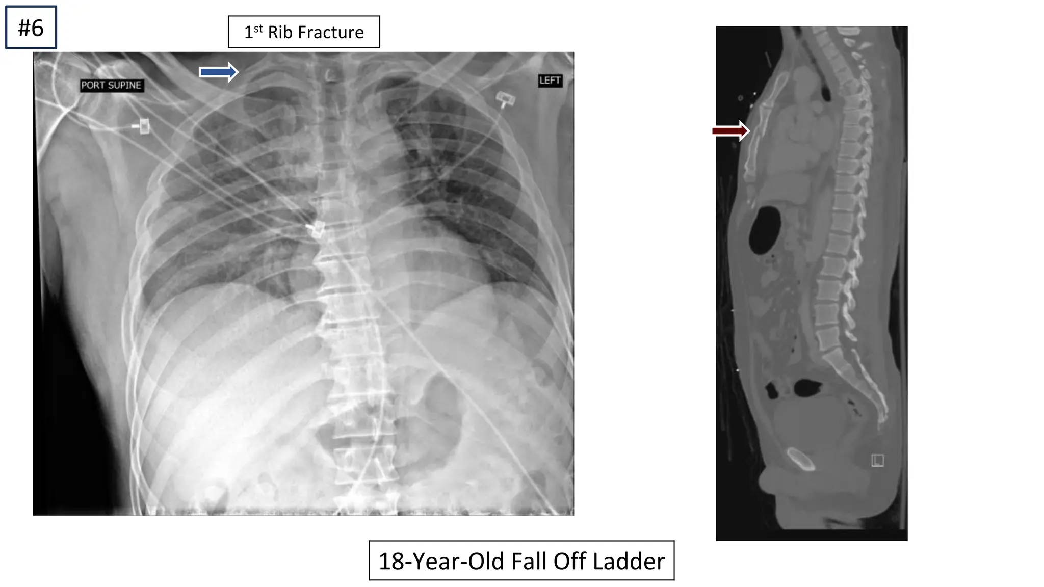 Sternal Fractures & Dislocations - EMGuidewire Radiology Reading Room ...