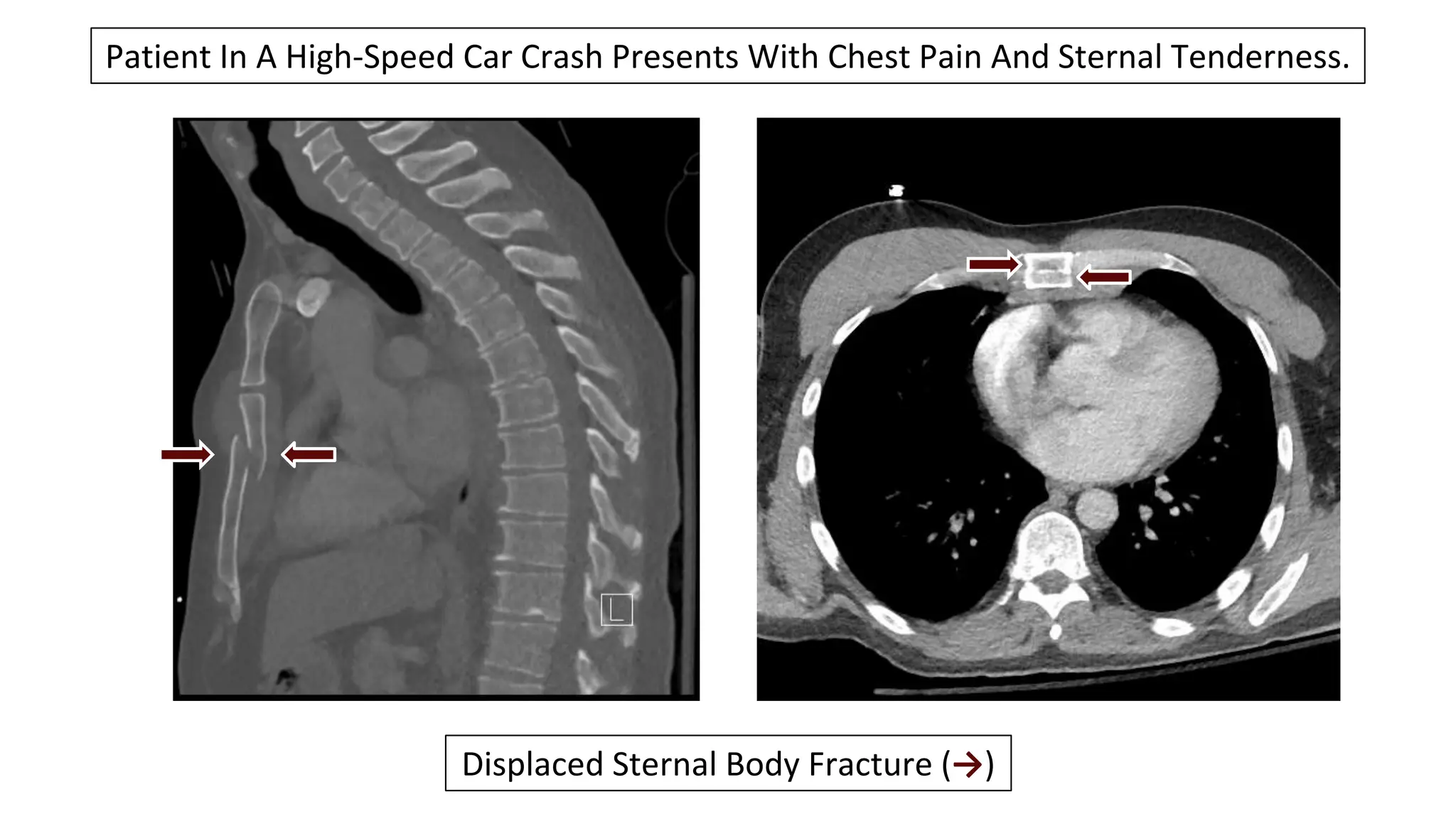 Sternal Fractures & Dislocations - EMGuidewire Radiology Reading Room ...