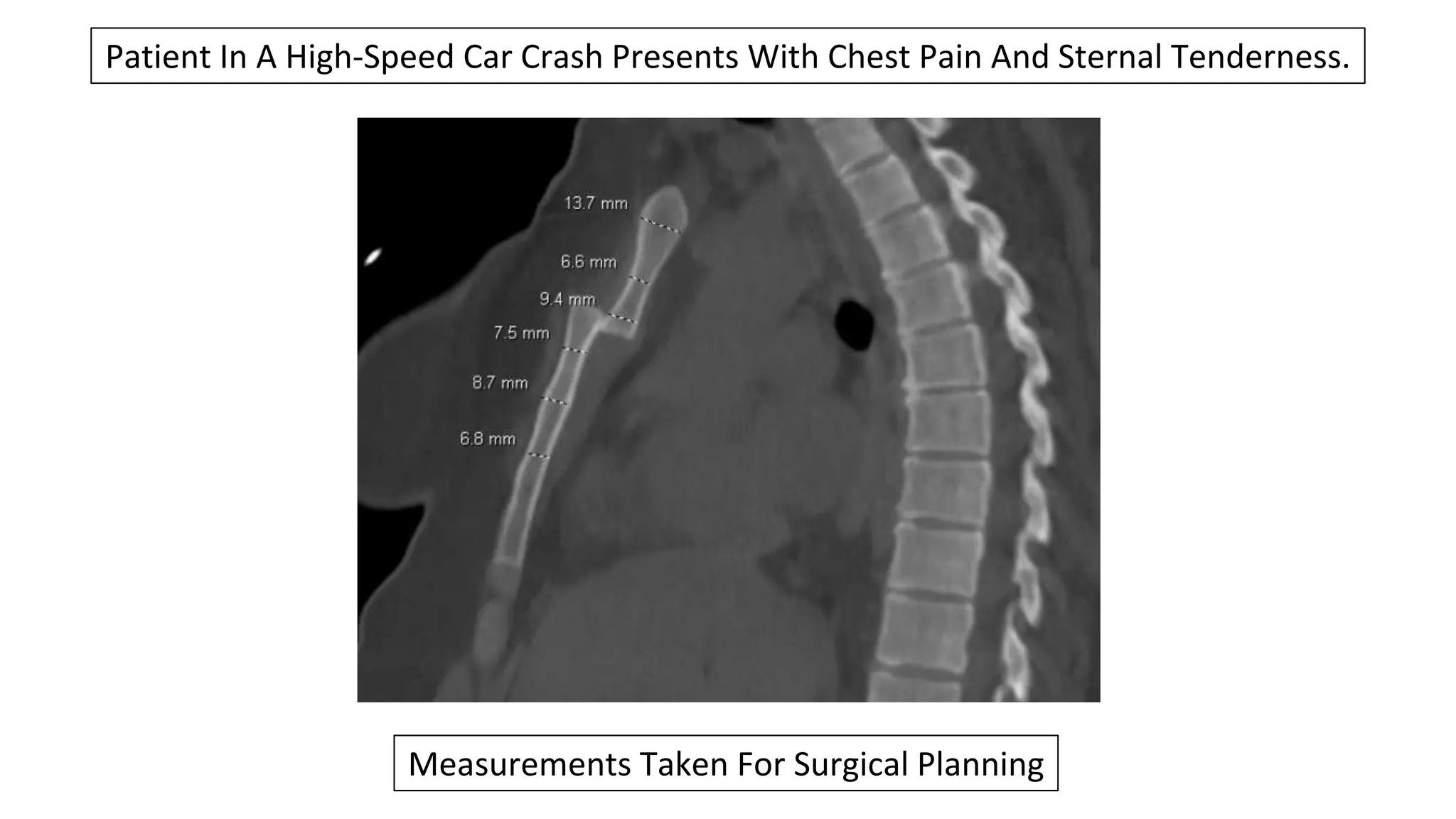 Sternal Fractures & Dislocations - EMGuidewire Radiology Reading Room ...