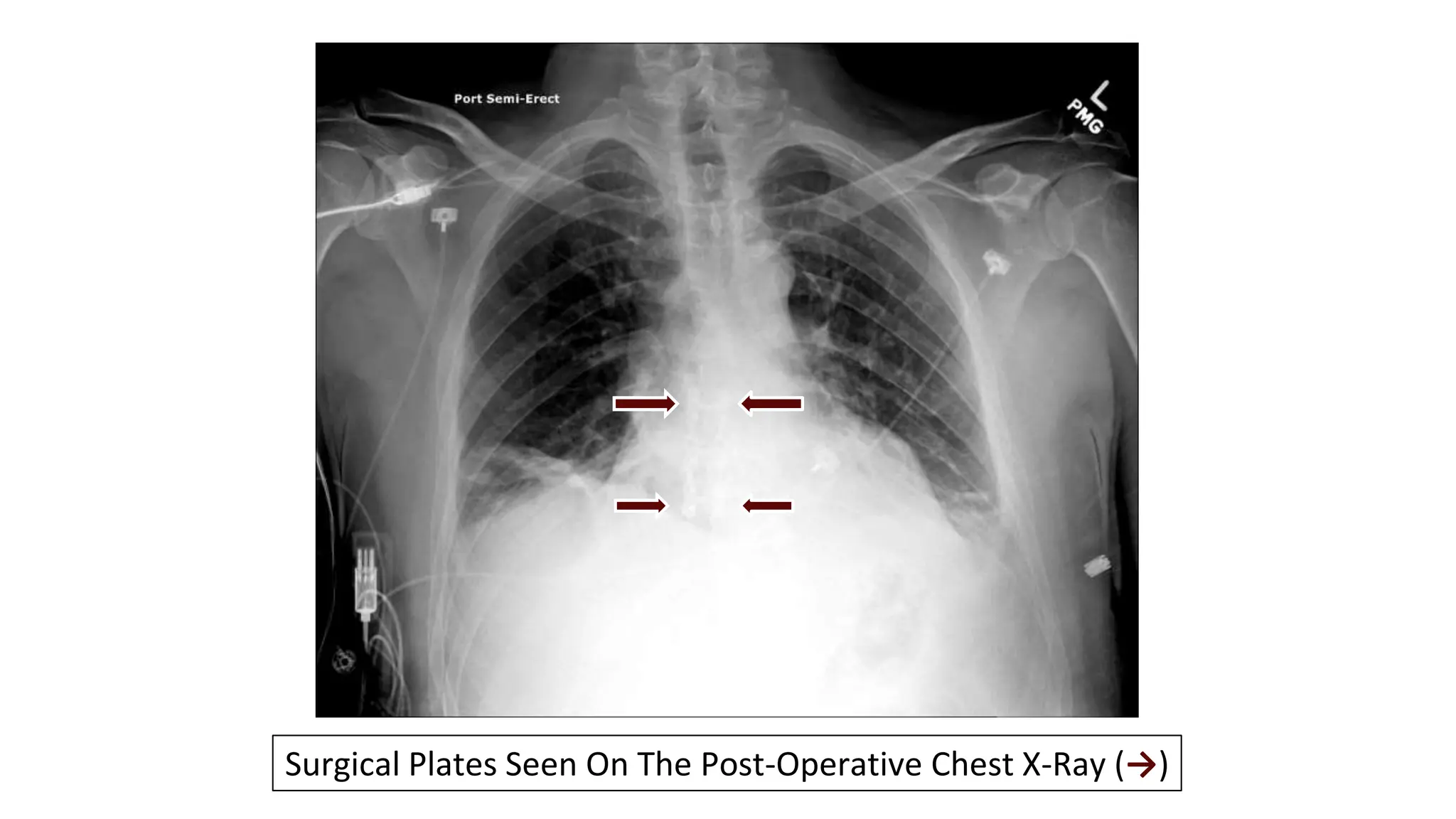 Sternal Fractures & Dislocations - EMGuidewire Radiology Reading Room ...