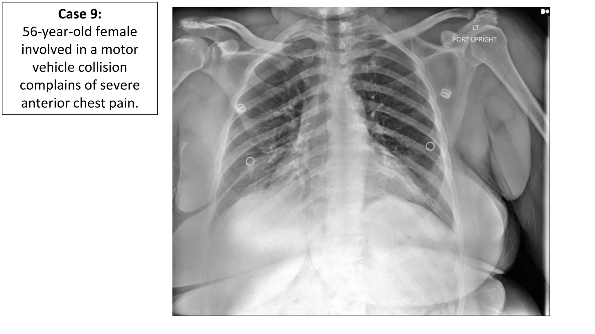 Sternal Fractures & Dislocations - EMGuidewire Radiology Reading Room ...