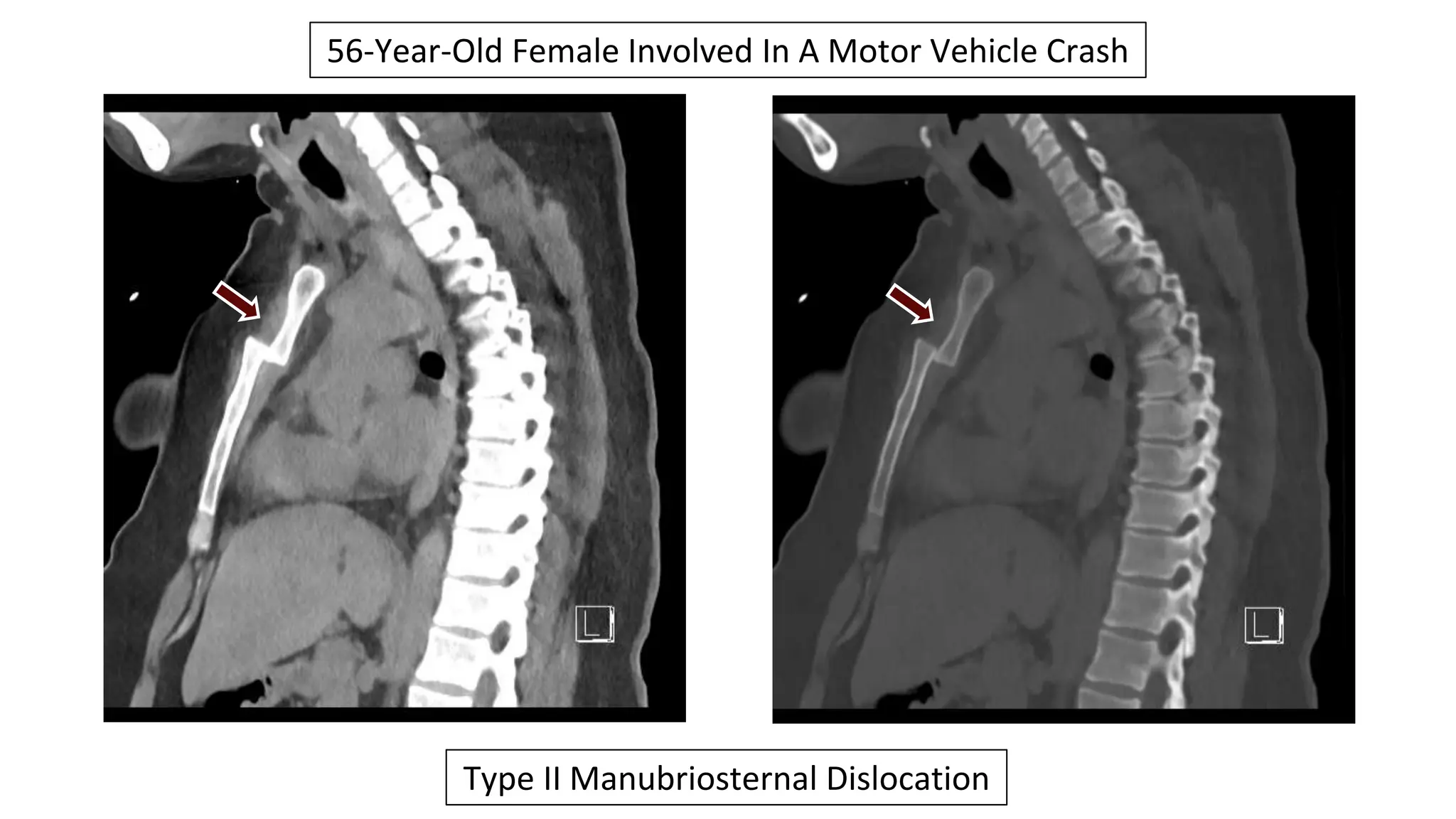 Sternal Fractures & Dislocations - EMGuidewire Radiology Reading Room ...