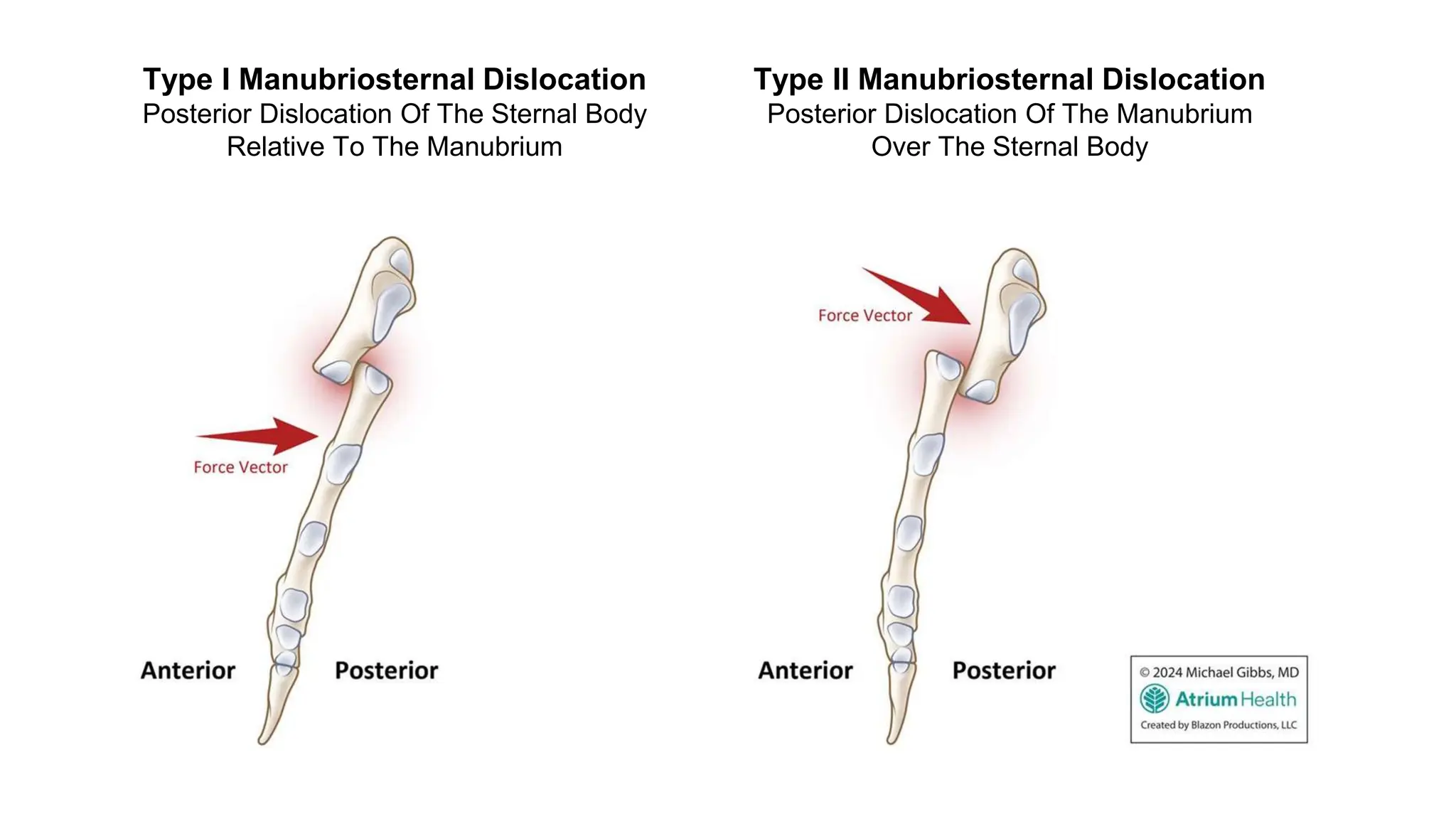 Sternal Fractures & Dislocations - EMGuidewire Radiology Reading Room ...