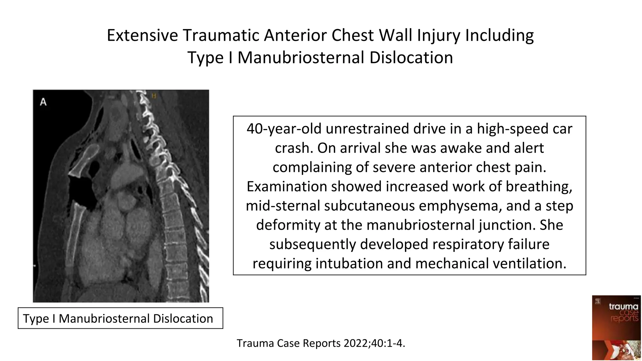 Sternal Fractures & Dislocations - EMGuidewire Radiology Reading Room ...