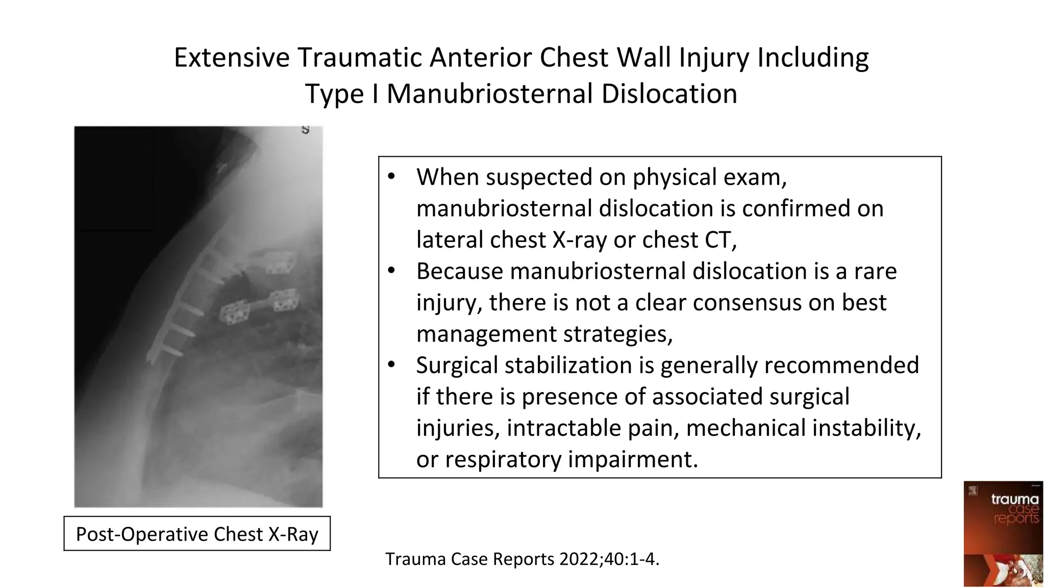 Sternal Fractures & Dislocations - EMGuidewire Radiology Reading Room ...