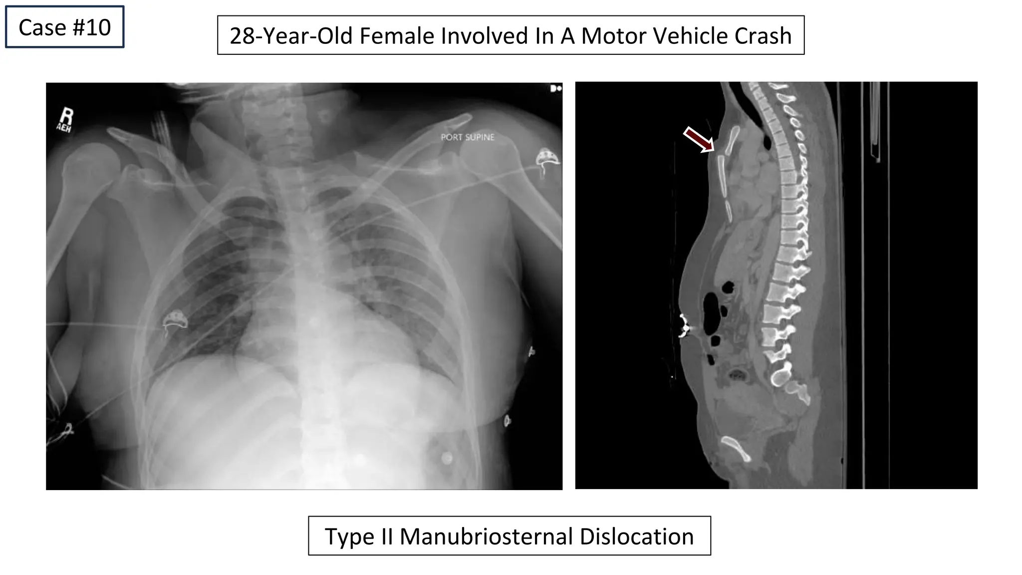 Sternal Fractures & Dislocations - EMGuidewire Radiology Reading Room ...