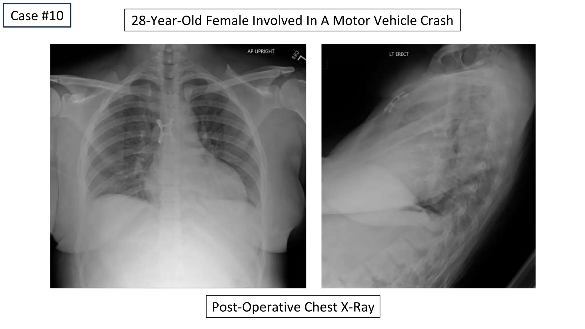 Sternal Fractures & Dislocations - EMGuidewire Radiology Reading Room ...