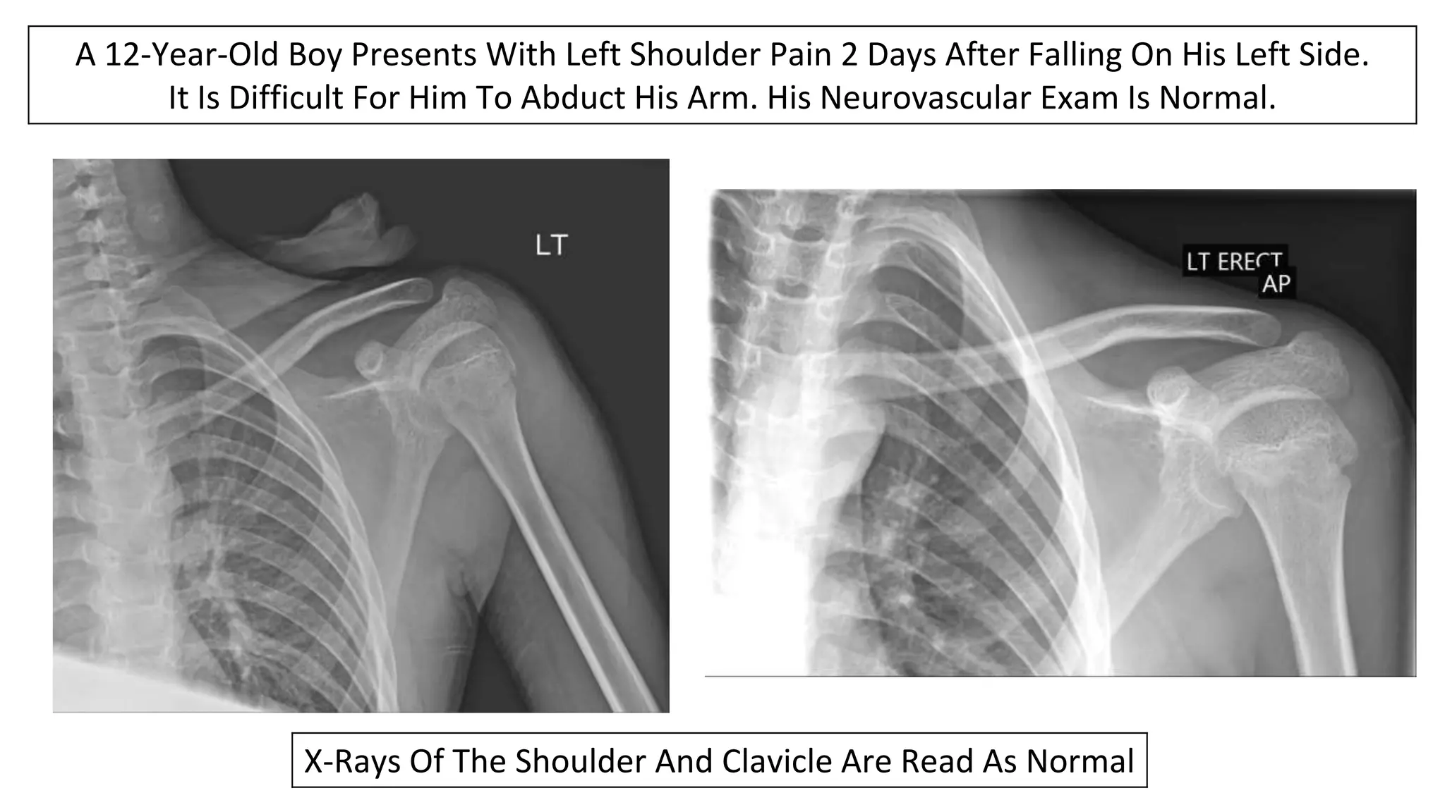 Sternal Fractures & Dislocations - EMGuidewire Radiology Reading Room ...