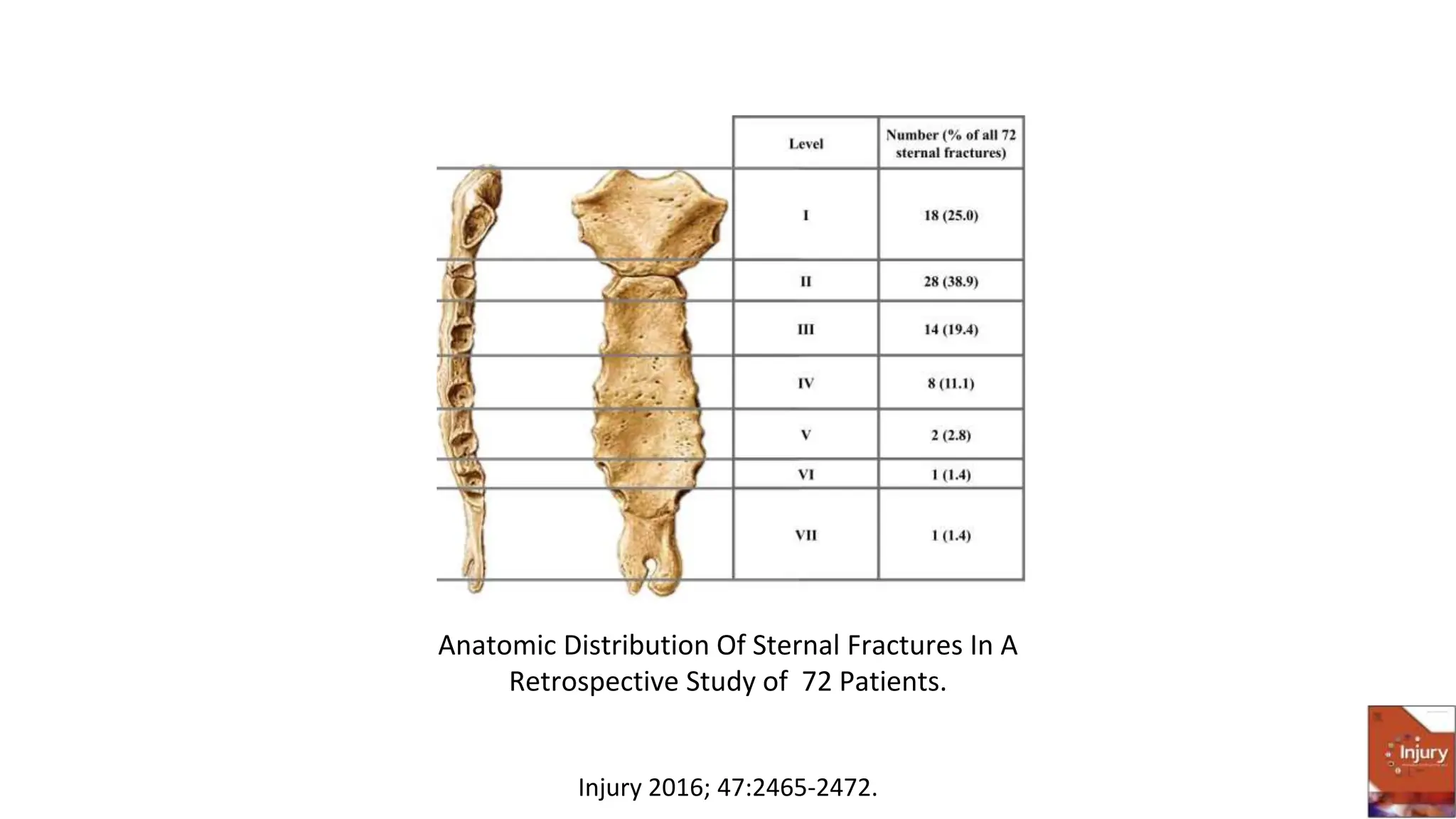 Sternal Fractures & Dislocations - EMGuidewire Radiology Reading Room ...