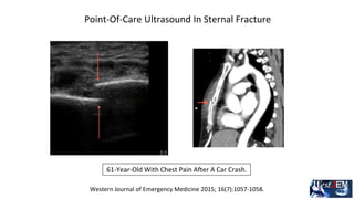Sternal Fractures & Dislocations - EMGuidewire Radiology Reading Room ...