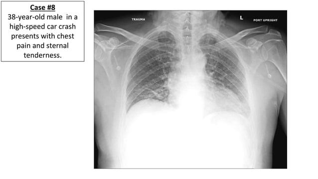 Sternal Fractures & Dislocations - EMGuidewire Radiology Reading Room ...