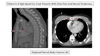 Sternal Fractures & Dislocations - EMGuidewire Radiology Reading Room ...
