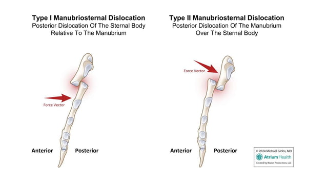 Sternal Fractures & Dislocations - EMGuidewire Radiology Reading Room ...