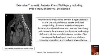 Sternal Fractures & Dislocations - EMGuidewire Radiology Reading Room ...