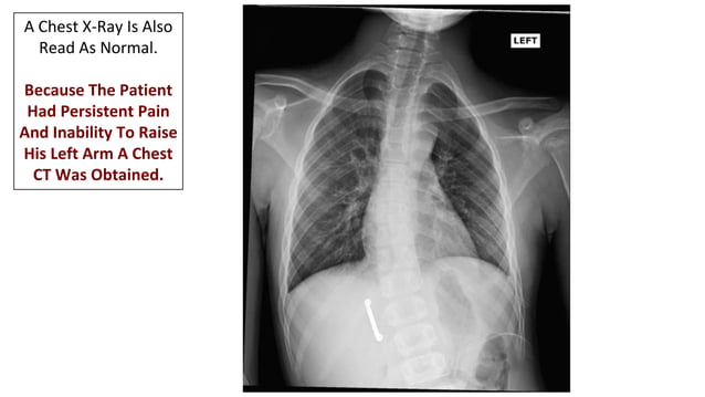 Sternal Fractures & Dislocations - EMGuidewire Radiology Reading Room ...