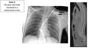 Sternal Fractures & Dislocations - EMGuidewire Radiology Reading Room ...
