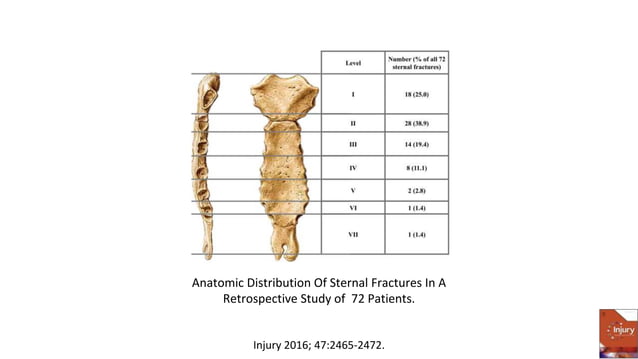 Sternal Fractures & Dislocations - EMGuidewire Radiology Reading Room ...