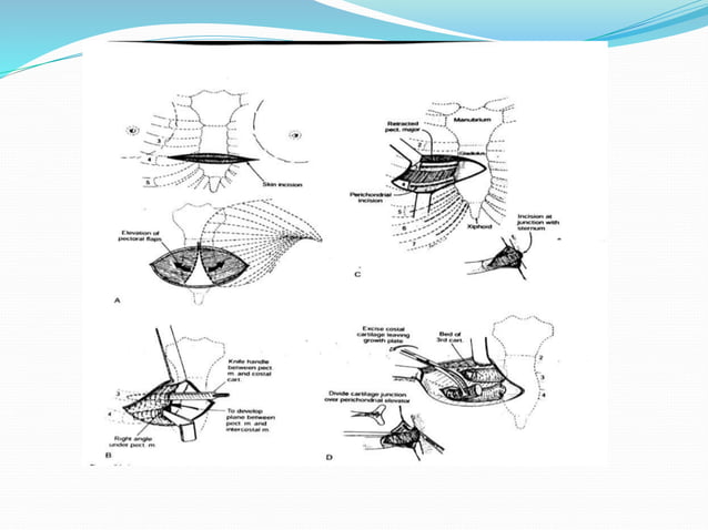 Sternal/ Chest wall deformities and Tumors | PPTX | Lung and ...