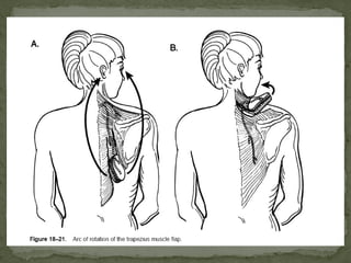 Sternocleidomastoid Muscle Flap in neck dissection.pptx
