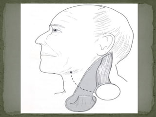 Sternocleidomastoid Muscle Flap in neck dissection.pptx