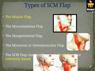 Sternocleidomastoid Muscle Flap in neck dissection.pptx