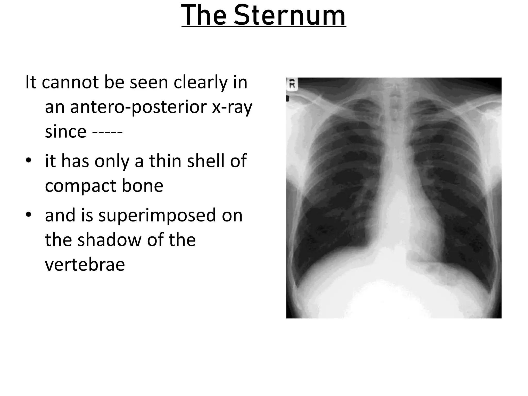 Sternum.pptx | Death, Injury, or Military Conflict | Sensitive Topics