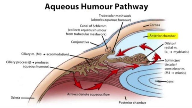 Steroid induced glaucoma