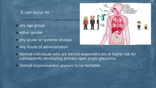 Steroid Induced Glaucoma - Dr Shylesh B Dabke | PPTX