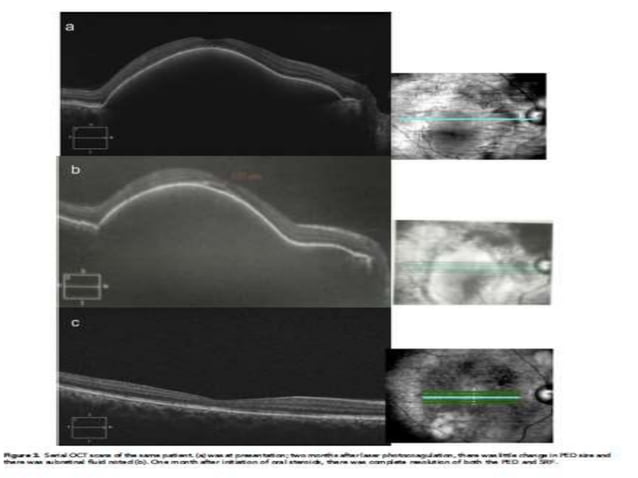 Steroid in IPCV BY DR.PUSHKAR DHIR.pptx