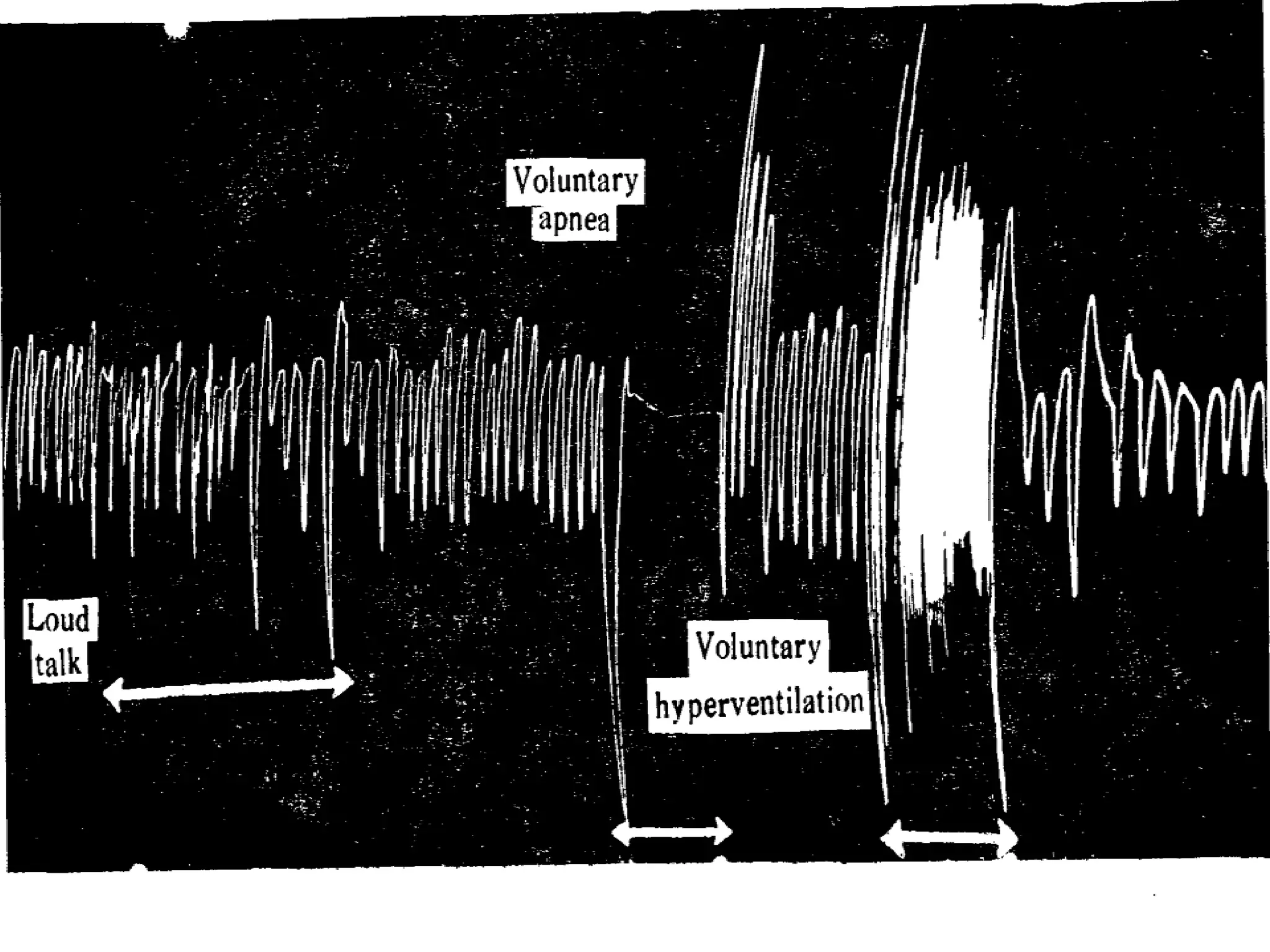 Stethograph- Recording Respiratory Movements | PPTX