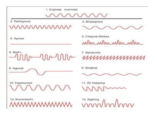 Stethograph- Recording Respiratory Movements | PPTX