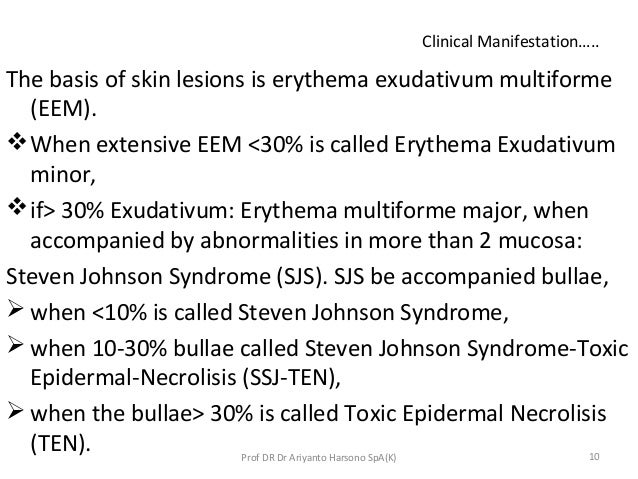 Steven Johnson Syndrome Target Lesion
