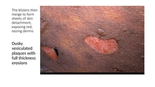 STEVEN JOHNSONS SYNDROME AND TOXIC EPIDERMAL NECROLYSIS [Autosaved] 2.pptx