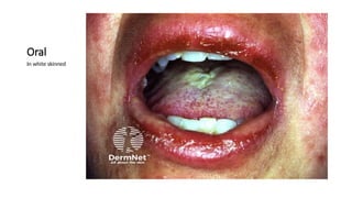 STEVEN JOHNSONS SYNDROME AND TOXIC EPIDERMAL NECROLYSIS [Autosaved] 2.pptx