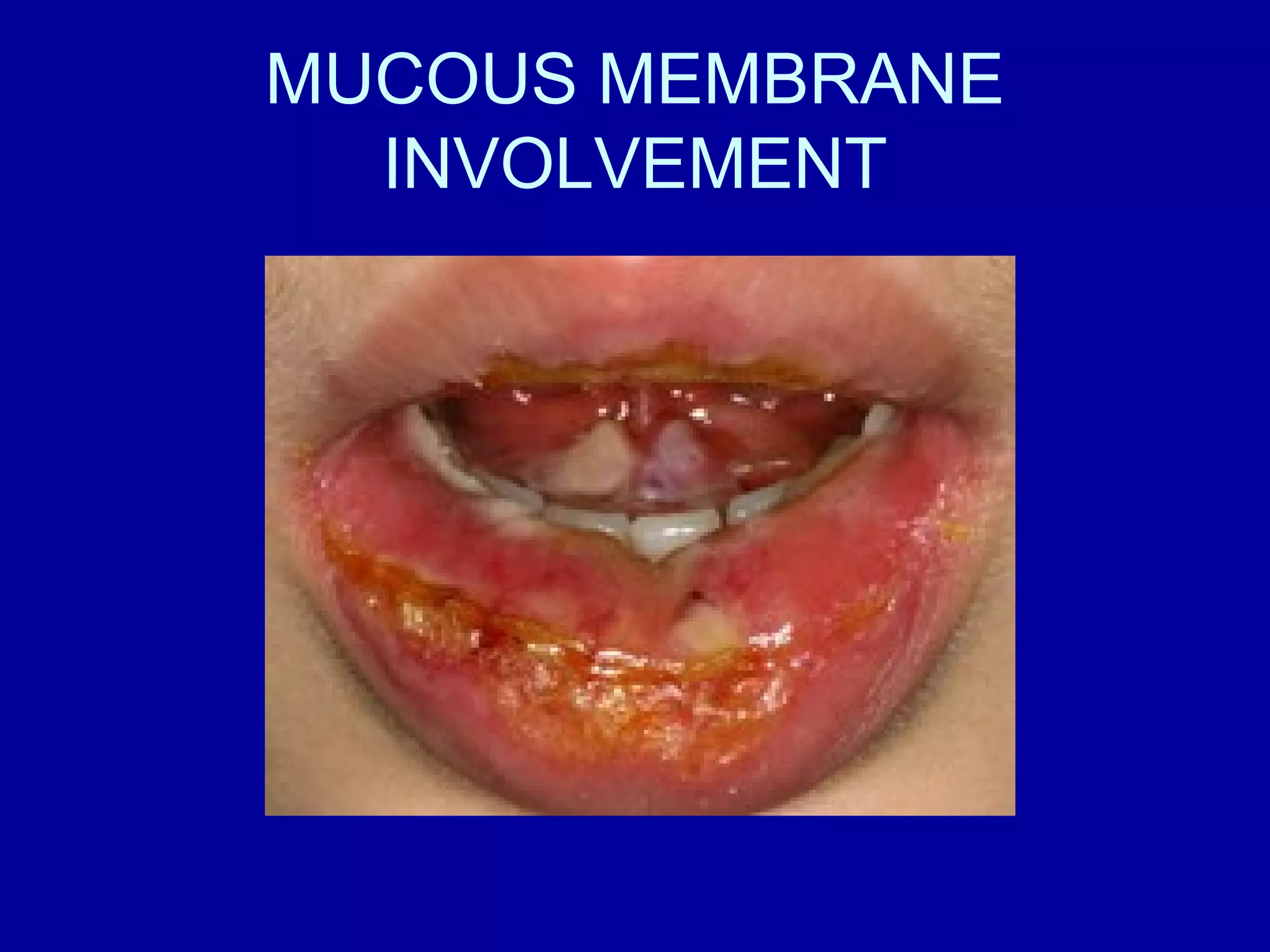 Stevens Johnson Syndrome | PPT