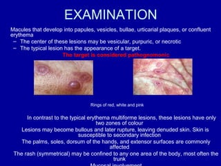 Stevens Johnson Syndrome Hands