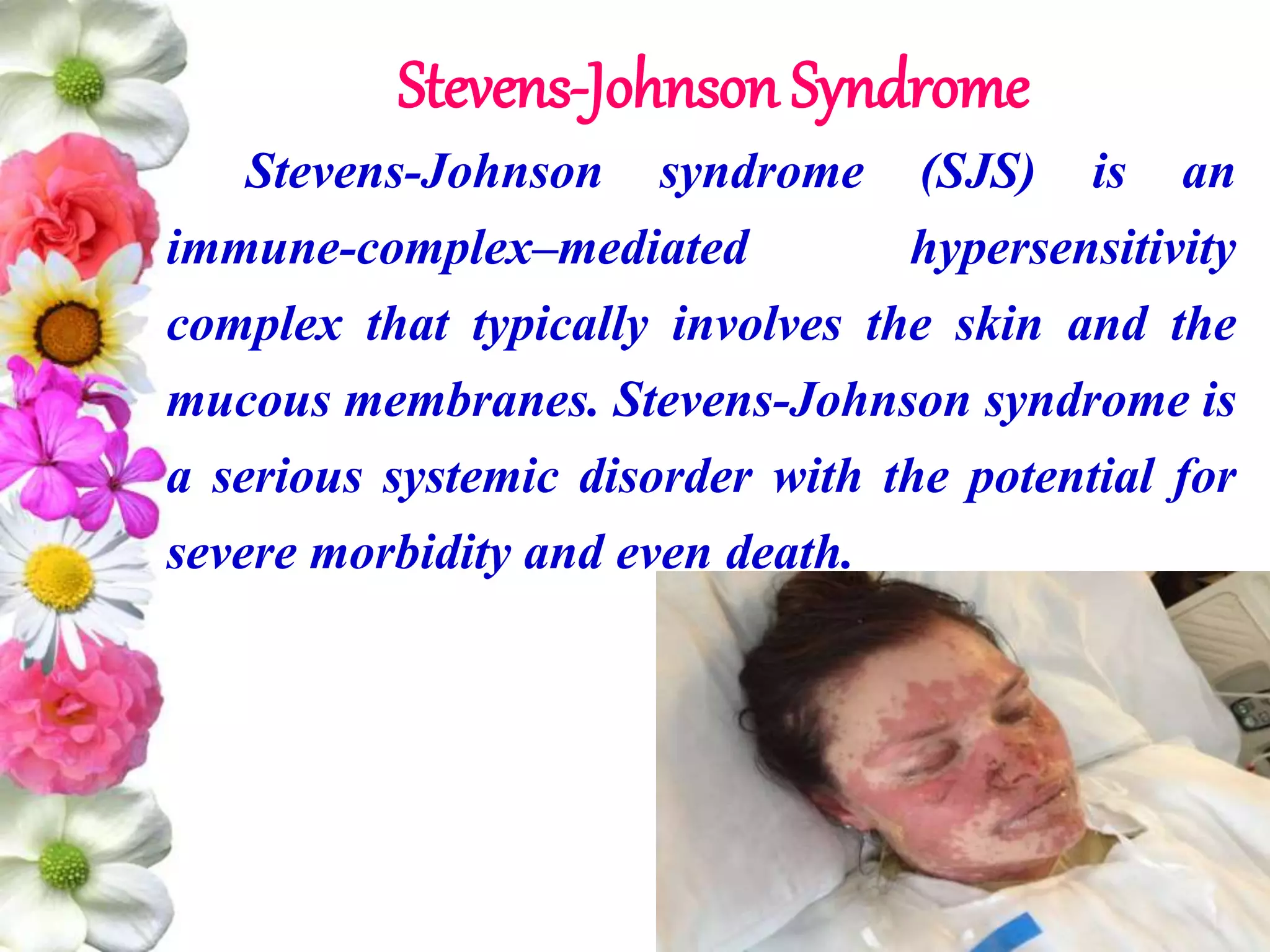 Steven johnson syndrome- | PPTX